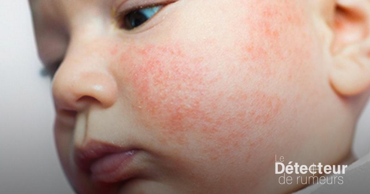 L’eczéma des enfants causé par des allergies alimentaires? Rarement ...