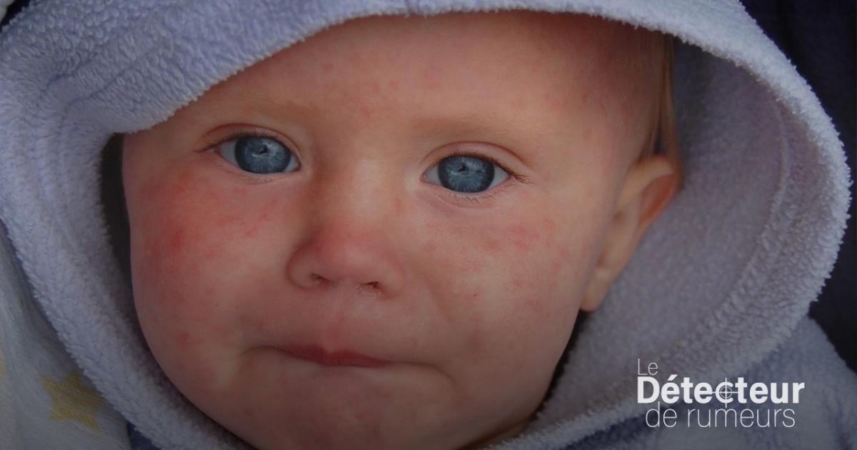 Résurgence de la rougeole en Europe: faut-il s’inquiéter? | Agence ...