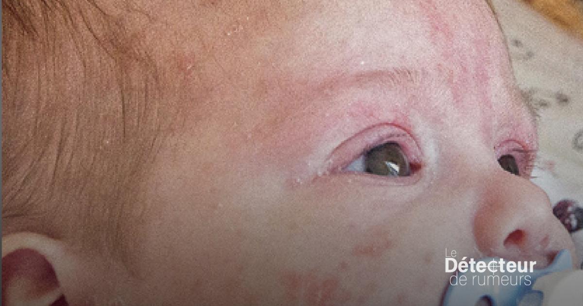 Rougeole: le risque d’une grande éclosion est faible au Québec? Vrai ...