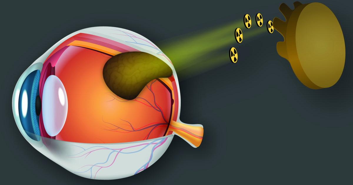 L’impression 3D pour traiter le cancer de l’œil | Agence Science-Presse